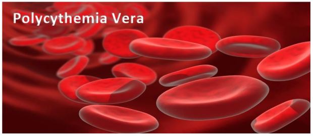 Polycythemia Vera – Dose of Nursing